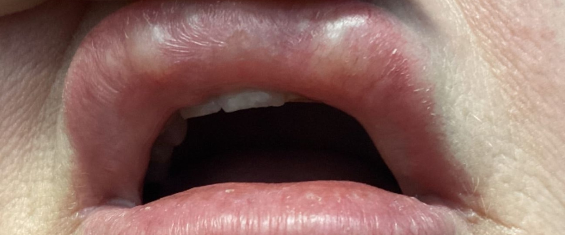 How to get rid of filler lumps?