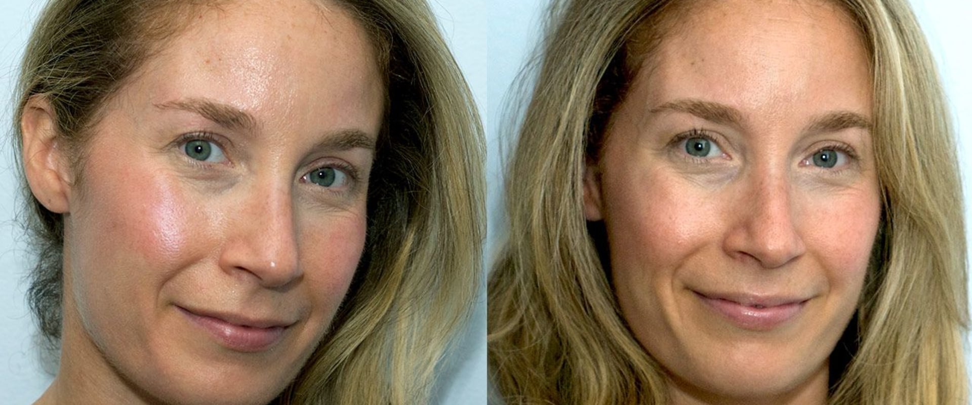 Do fillers get better over time?